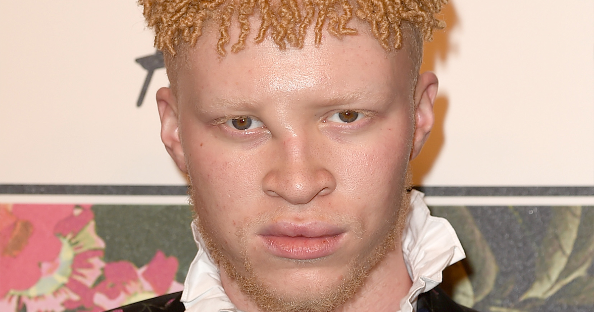 Shaun Ross Bump On Face